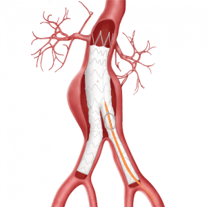 Covera Plus – Stent Revestido Autoexpansivel – Medicicor – 71 3351-2000