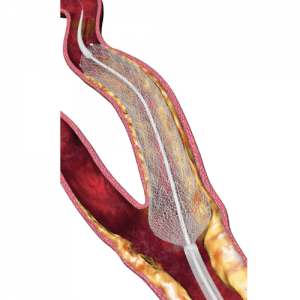 C-Guard – Stent Carótideo – Medicicor – 71 3351-2000